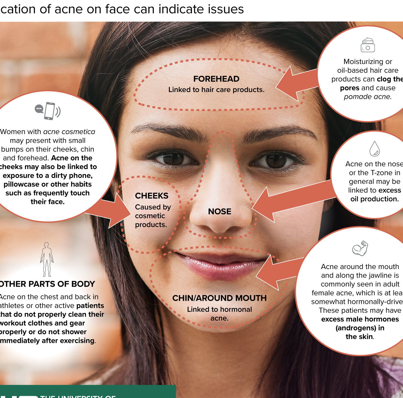 The Meaning Of Acne Understanding The Causes And Solutions Meaning The Meaning Of Acne Understanding The Causes And Solutions Meaning